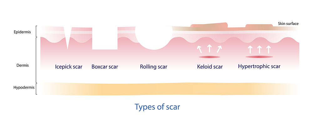Keloid Scar Concerns | Professional Scar Management